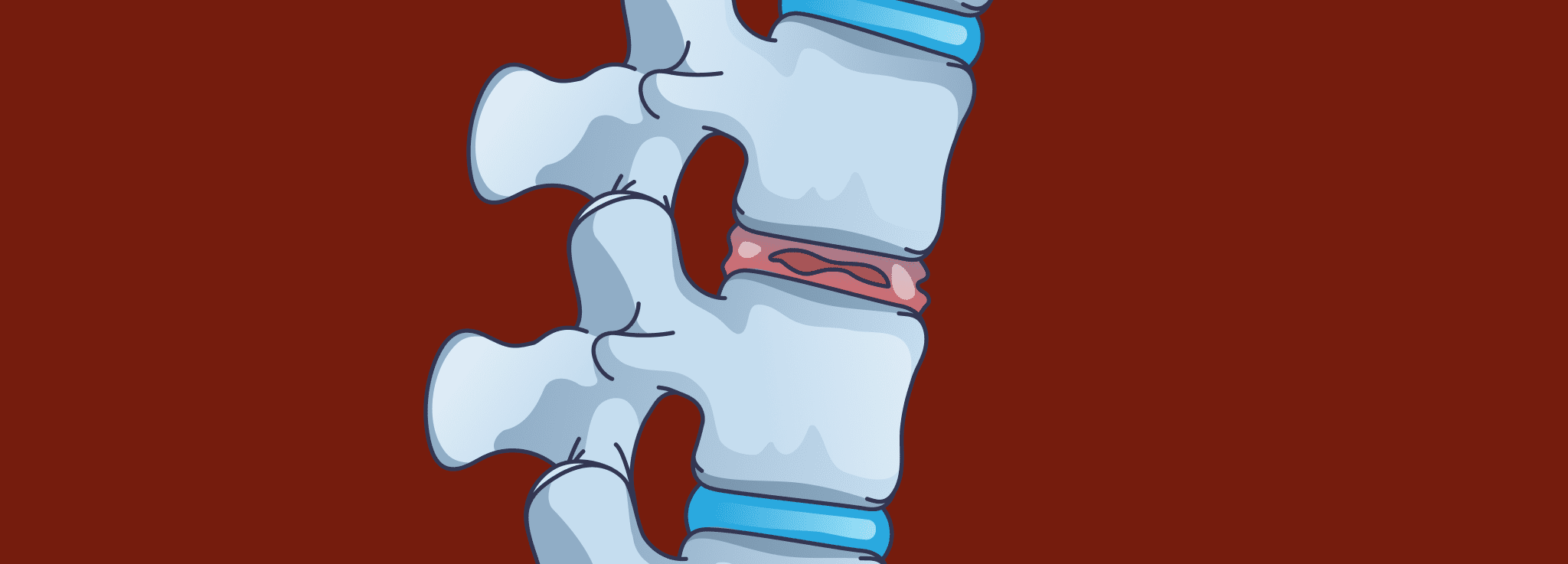 Annular Disc Tear | National Spine Health Foundation