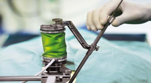 Robotically-Guided Minimally Invasive Lumbar Fusion Surgery | National ...