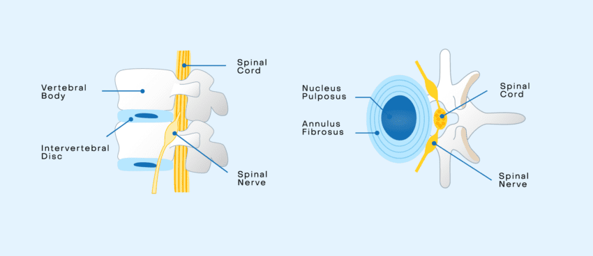 Degenerative Disc Disease | National Spine Health Foundation