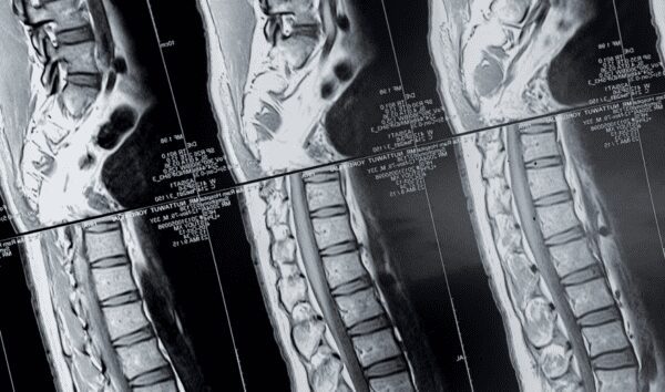 Myelograms | MRI | Image Scans | Spine Health