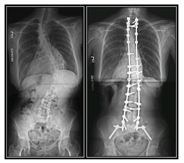 Spinal Fusion Before And After
