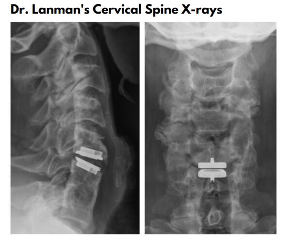 The Unstoppable Dr. Lanman | National Spine Health Foundation
