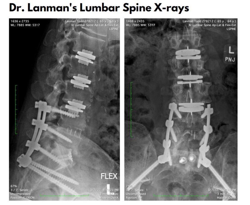 The Unstoppable Dr. Lanman | National Spine Health Foundation
