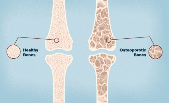 Osteoporosis And The Spine | National Spine Health Foundation