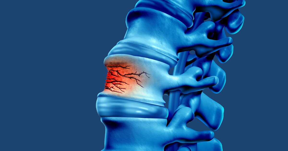 Managing Osteoporotic Compression Fractures National Spine Health