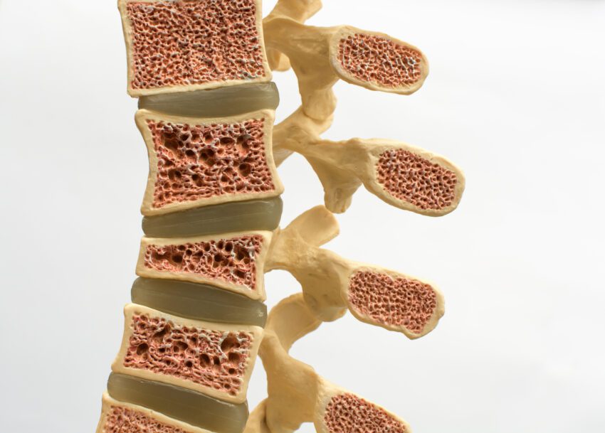 Managing Osteoporotic Compression Fractures | National Spine Health ...