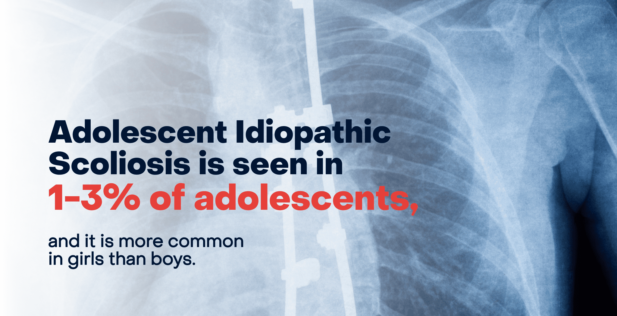 Adolescent Idiopathic Scoliosis: What You Need to Know | National Spine ...