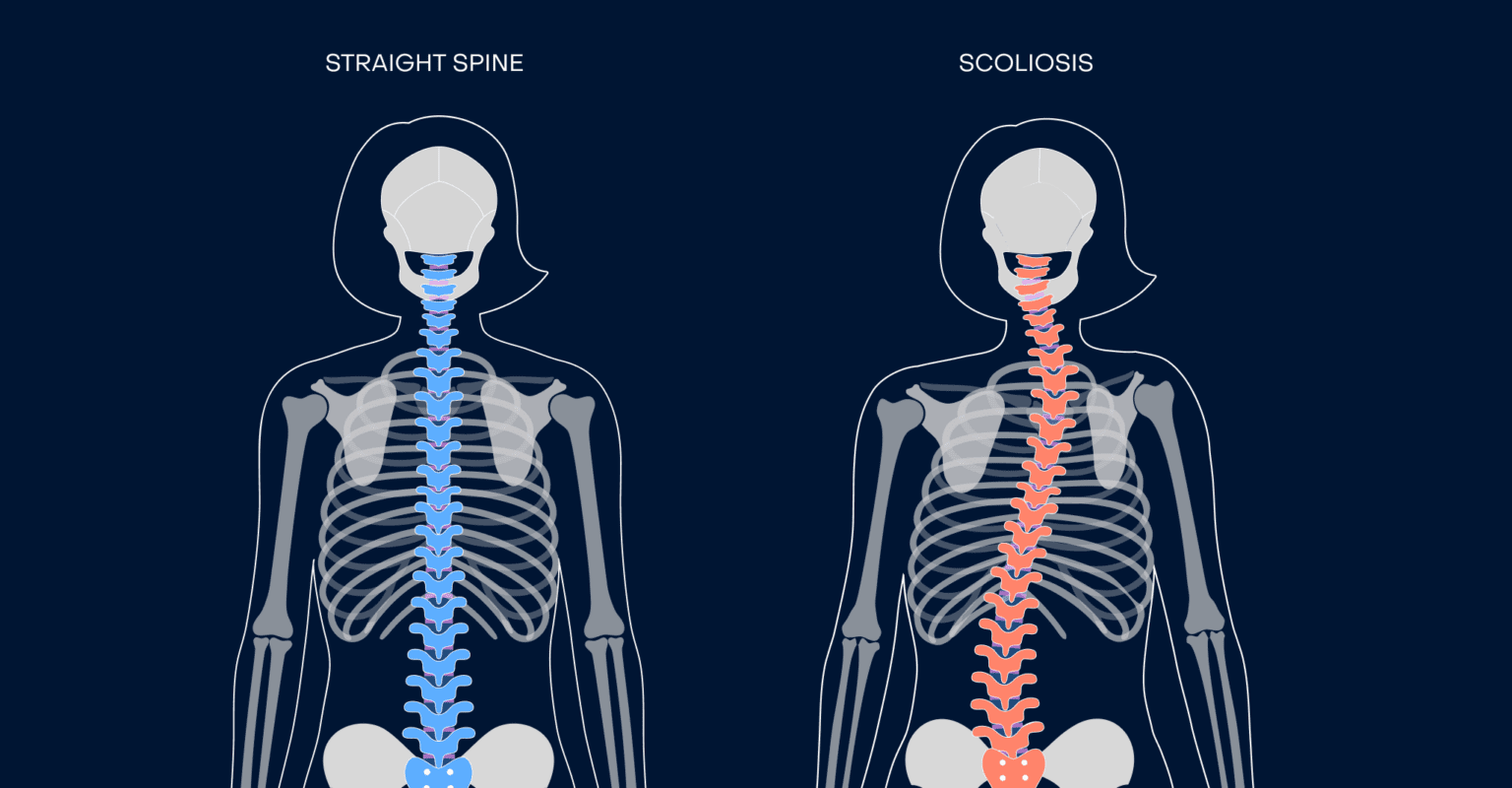 Adolescent Scoliosis | National Spine Health Foundation