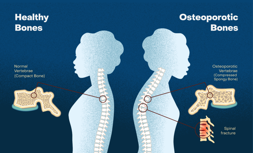 Bone Hub - For Women 50+ | National Spine Health Foundation