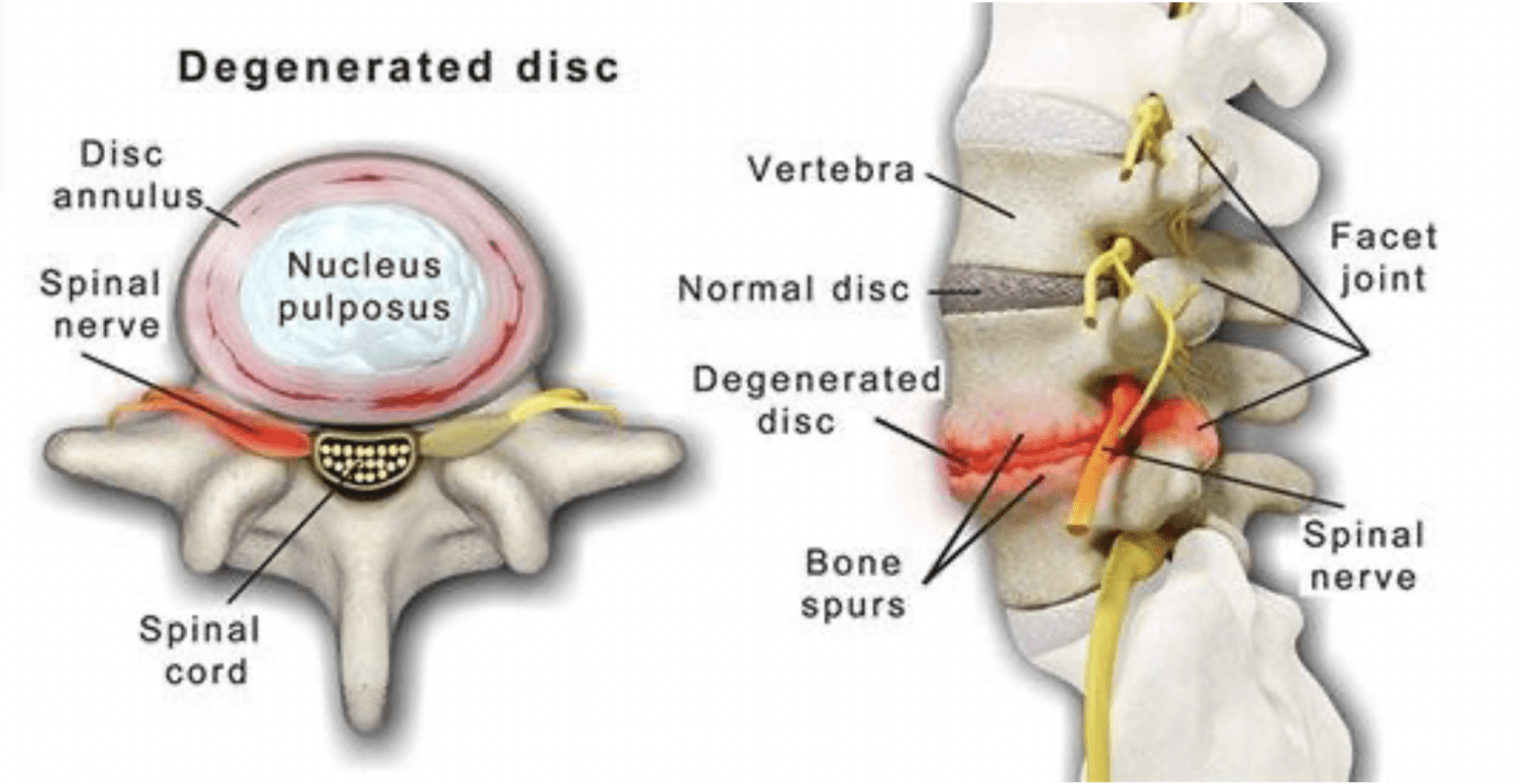 Common Conditions That Hinder Spinal Motion | National Spine Health ...