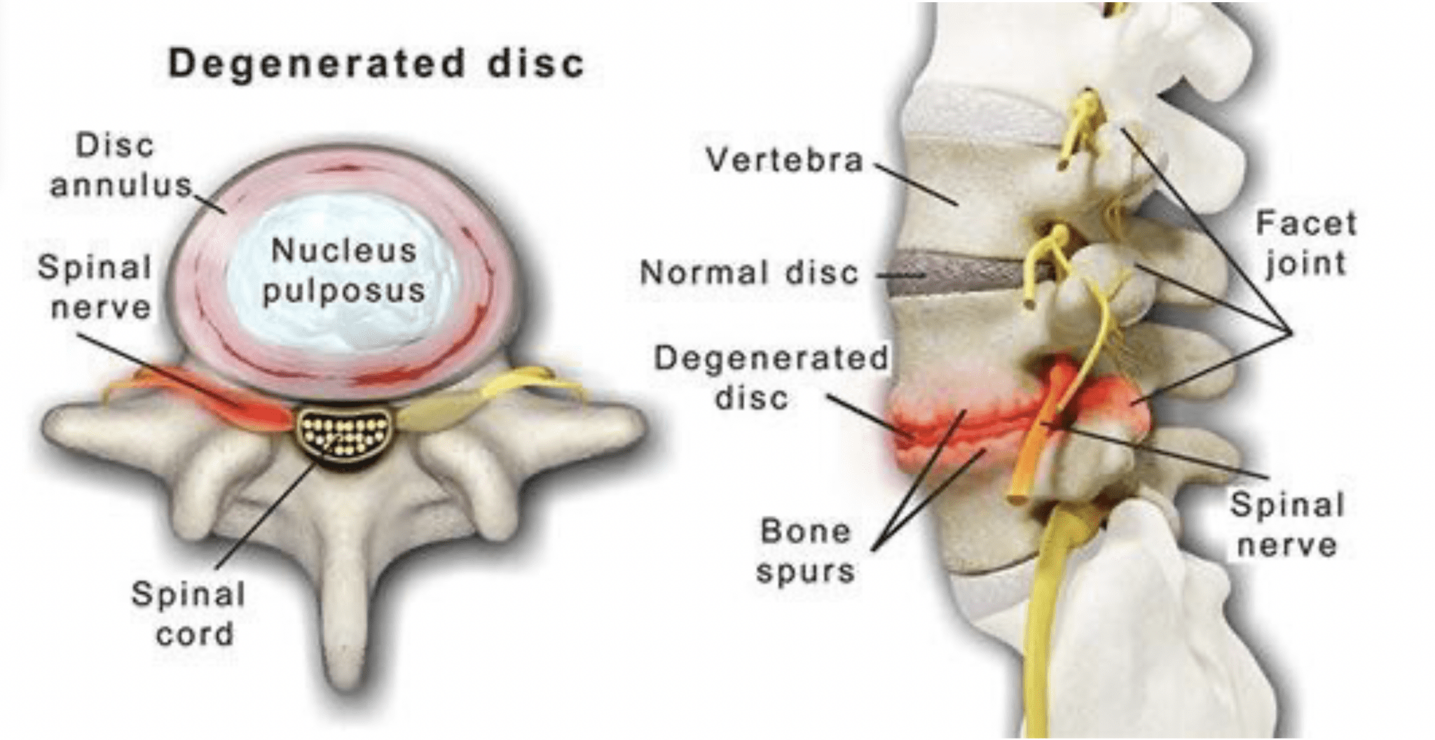 Common Conditions That Hinder Spinal Motion | National Spine Health ...