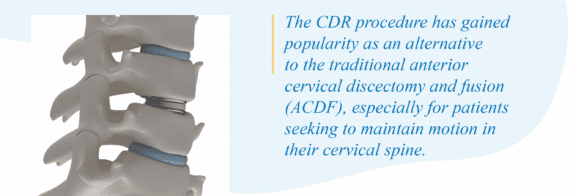 Cervical Arthroplasty Explained: A Comprehensive Overview | National ...