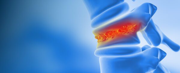 Understanding Spinal Compression Fractures and Preventing the Next One ...